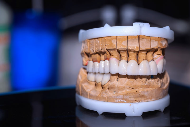 Am I Able To Replace A Full Arch Of Missing Or Damaged Teeth ...